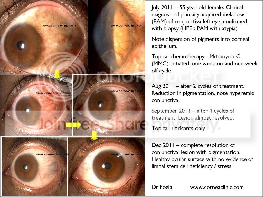 Primary Acquired Melanosis